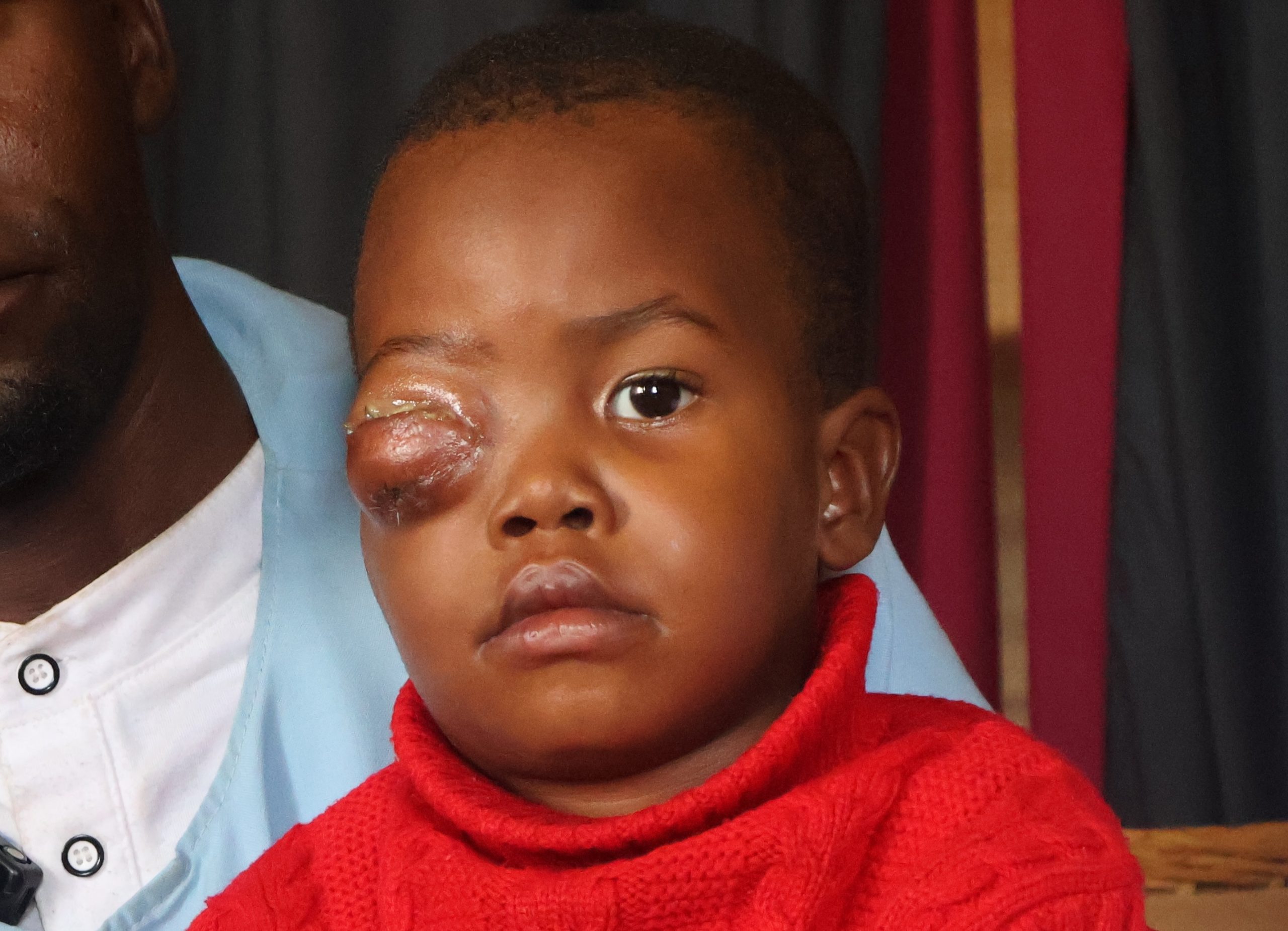 Nearly a quarter of children diagnosed with rare eye cancer in Africa ...